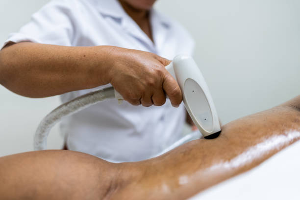 Laser transdérmico: o que é e como funciona o tratamento de varizes e ...