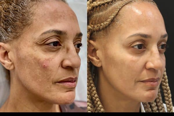 Fotona Starwalker®: o laser de última geração para tratamentos ...